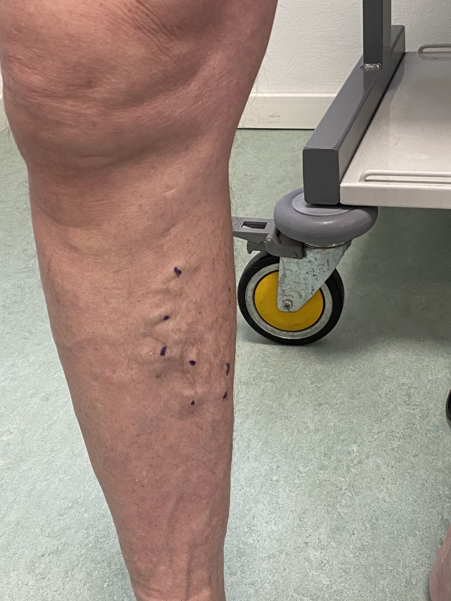 Flebektomi behandling af Åreknuder København